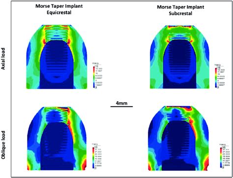 von mises stress distribution within the peri implant bone for the download scientific diagram