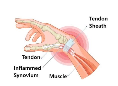 De Quervain S Tenosynovitis Symptoms And Options For Treatment