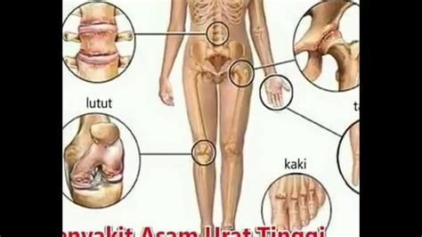 TERBUKTI Ini Dia Tanaman Obat Asam Urat Yang Ampuh Dan Berkhasiat YouTube