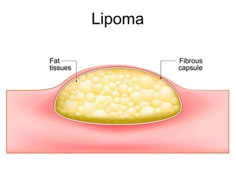 Fatty Lipoma Causes And Treatment Venice FL
