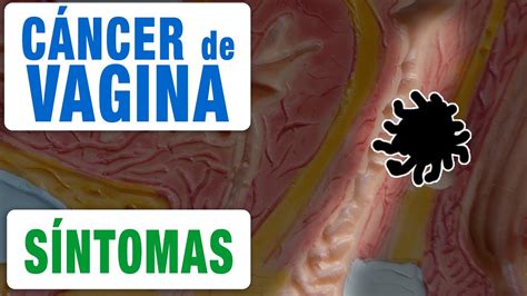 Sintomas De C Ncer Vulvar Braincp