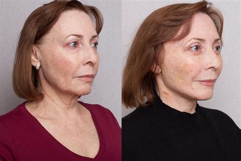 Фото До И После Подтяжки Кожи New Freepik Ru
