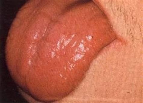 Vitamin B Deficiency Tongue