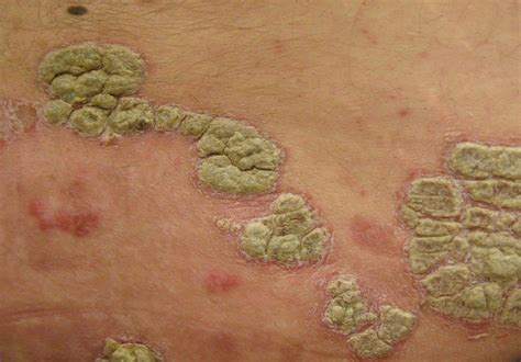 Psoriazis Cauze Simptome Tratament