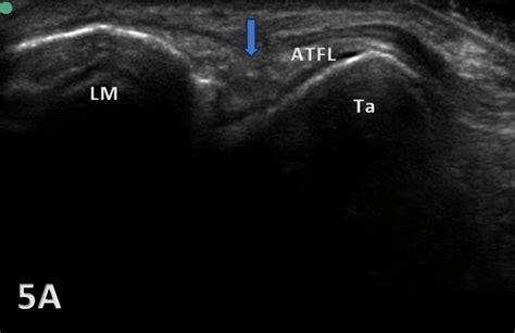 Enhancing The Diagnosis Of Lateral Ankle Sprains The Role Of MSK
