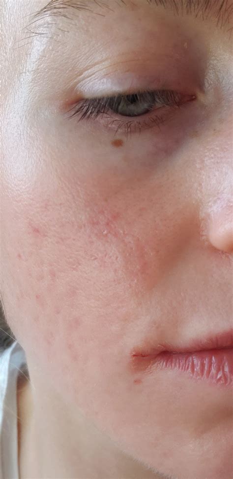 9 Month Accutane Transformation Before After Photos Crystal Clear
