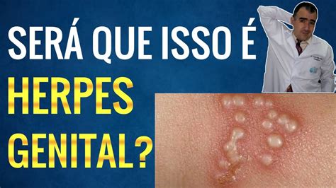 Como Feito O Diagn Stico De Herpes Genital Youtube