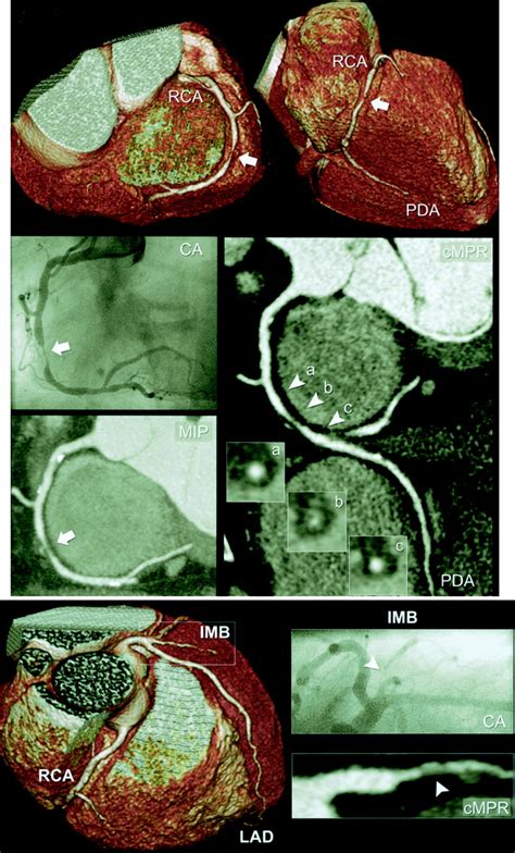High Resolution Spiral Computed Tomography Coronary Angiography In