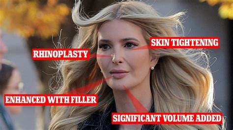 Plastic Surgeons Reveal Procedures Ivanka Trump May Have Had Daily