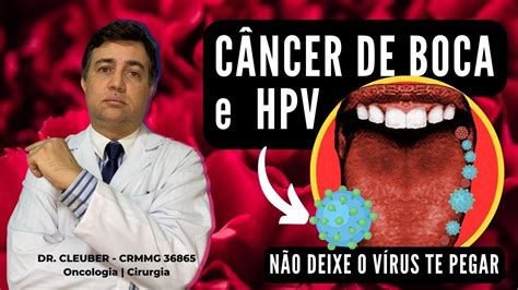 CÂNCER DE BOCA E HPV Sintomas e Tratamento YouTube