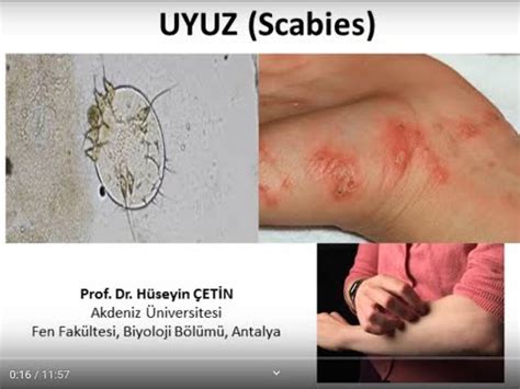 Uyuz Nedir Belirtileri Nelerdir Uyuz I In Ev Ila Lanmal M D R Prof