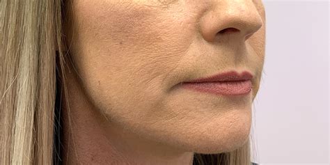 Jawline Fillers Case No 1380 Albany Cosmetic And Laser Centre