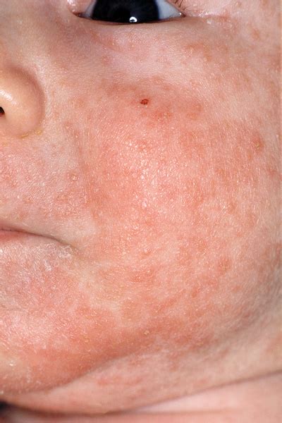 Identifying Skin Lesions