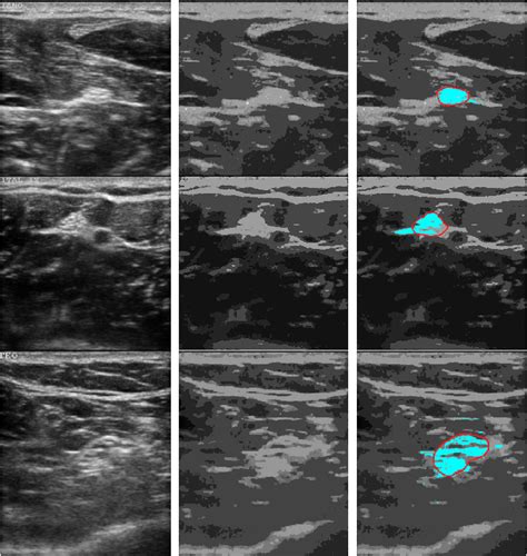 figure 3 from peripheral nerve segmentation using nonparametric bayesian hierarchical clustering