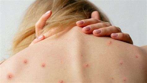 Mpox O Vaiolo Delle Scimmie Causa Sintomi Trasmissione E Cure