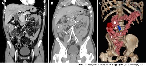 What Is The Sigmoid Colon