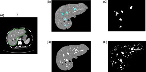 first case of tumors segmentation a segmented liver b liver tumors download scientific