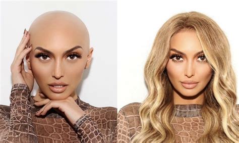 20 Female Celebrities With Hair Loss Wimpole Clinic