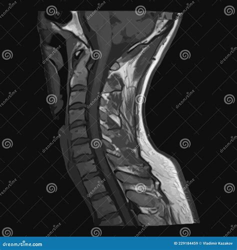 Realistic Image Sagittal Of Cervical Spine With CT Scan MRI Magnetic