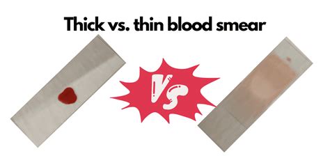 Differences Between A Thick And Thin Blood Smear Laboratoryintern