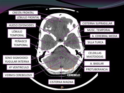 ANATOMÍA Tejido óseo EL CRÁNEO TC TAC Rx RADIOGRAFÍA