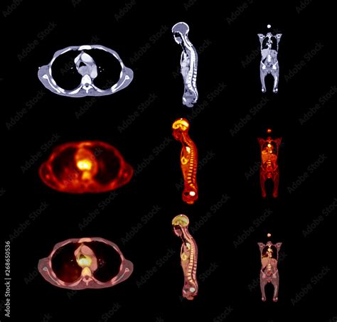 PET CT Scan Image Of Whole Body Comparison Axial Sagittal And Plane