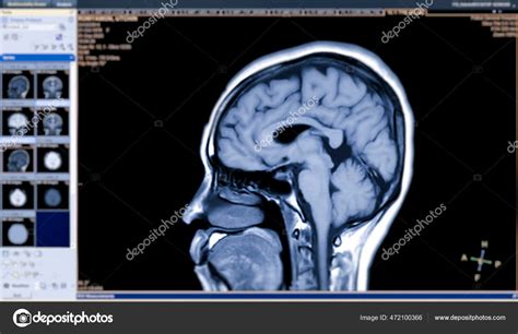Irm Vue Sagittale Cerveau Pour D Tecter Une Vari T Conditions Cerveau