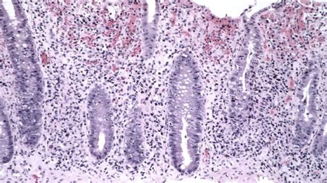 Lower Gi Pathology Physician S Channel Mount Sinai New York
