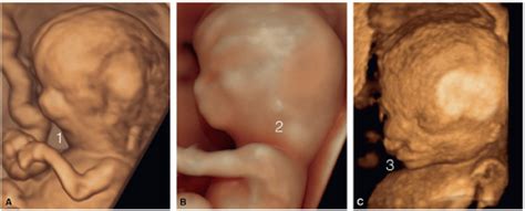 The Fetal Face And Neck Radiology Key