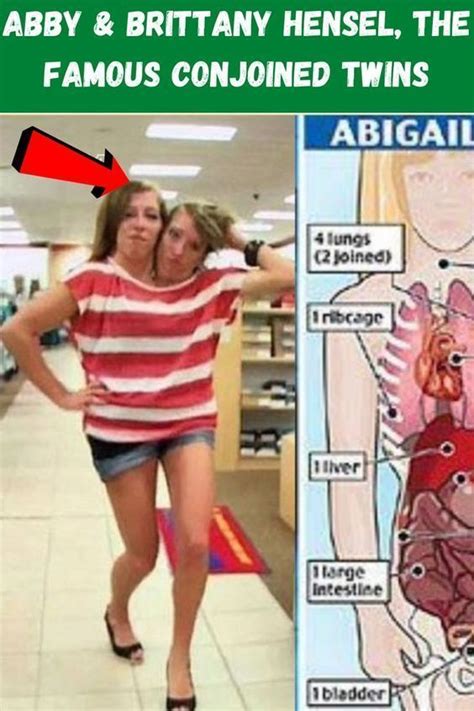 The Story Of Abby And Brittany Hensel The Famous Conjoined Twins Artofit