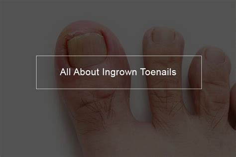 When Should You Go To The Doctor For An Ingrown Toenail
