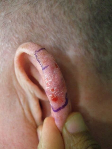Basal Cell Cancer Of The Rim Of The Ear Dr Vindy Ghura Dermatologist