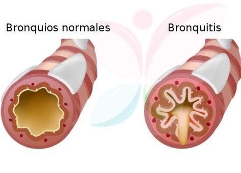 Conoce Hoy Mismo Cuales Son Los Tipos De Bronquitis Y Como Se