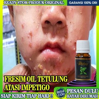 Jual Obat Impetigo Anak Obat Untuk Penyakit Impetigo Ringan Fresim Oil
