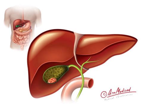 Gallbladder Cancer Symptoms Diagnosis And Treatment