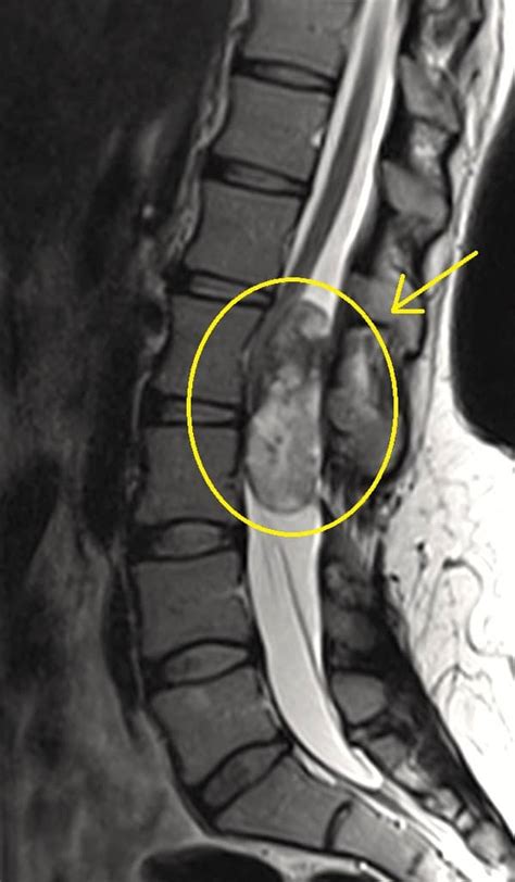 Dermoid And Epidermoid Cysts Dr Paul C Mccormick