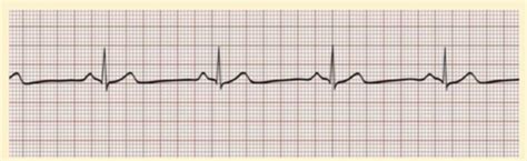 Ecg Strips Flashcards Quizlet