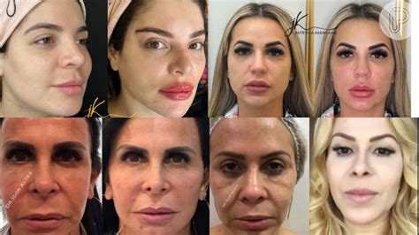 Deolane Gretchen Joelma Gkay E Mais Veja O Antes E Depois De