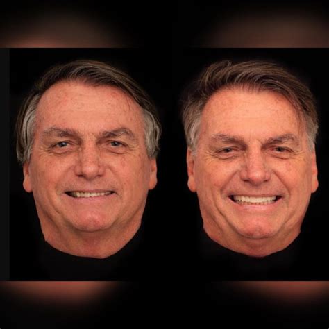 Bolsonaro faz harmonização facial de R 84 mil veja antes e depois
