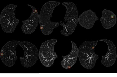 Lung Detr Deformable Detection Transformer For Sparse Lung Nodule