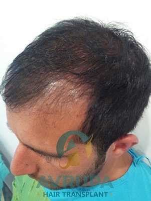 Trapianto Capelli Prima E Dopo 4345 Bulbi Chirurgia Estetica