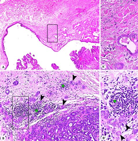 Stromal Tumor Infiltrating Lymphocytes TILs Within The Infiltrative
