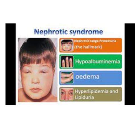 None Nephrotic Syndrome Treatment At Rs 2500 Pack In Noida ID