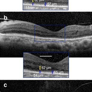 Series Of Spectral Domain Optical Coherence Tomography SD OCT Images