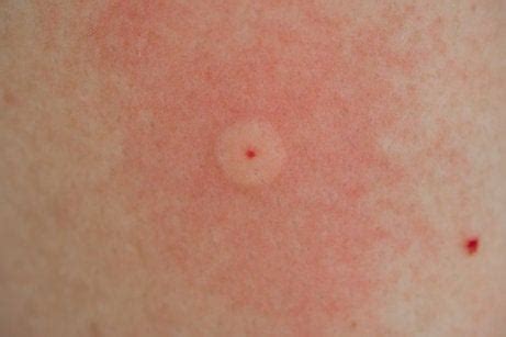 Picadura De Avispa Info