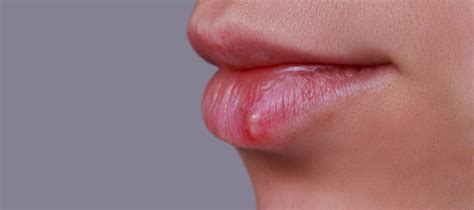 Herpes labial Causas prevención y tratamiento