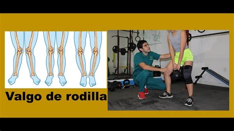 C Mo Corregir Piernas Arqueadas Rodillas En Valgo Youtube