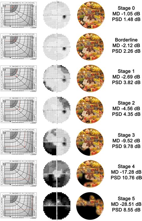 early glaucoma visual field defects