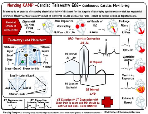 ECG Telemetry Monitoring Nurse Nurses Notes Nursing Mnemonics