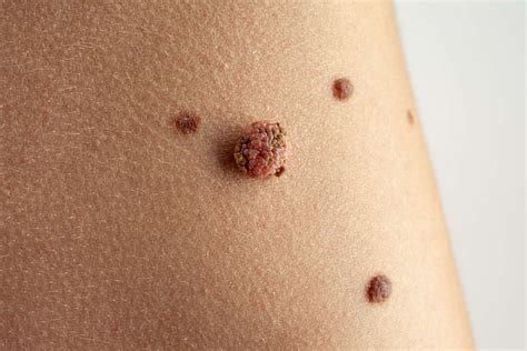 Quelle Est La Diff Rence Entre Un Carcinome Et Un M Lanome